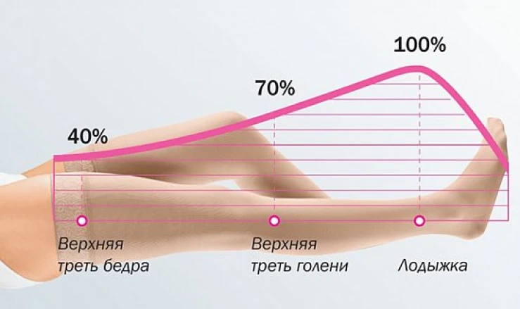 Компрессионный трикотаж в профилактике и лечении варикоза